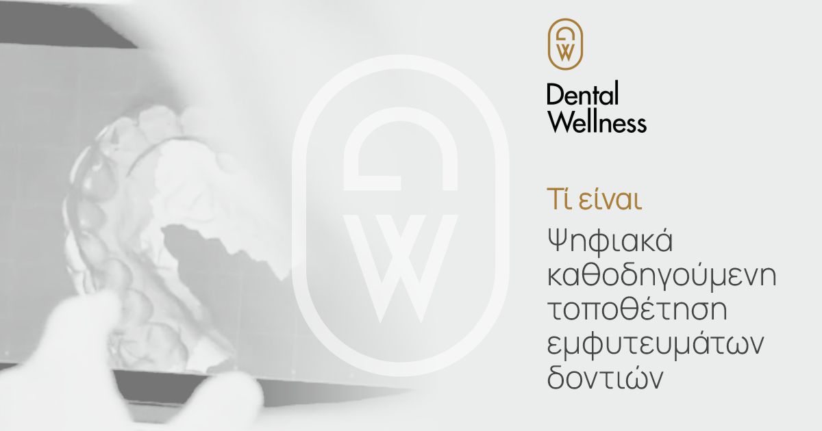 Τι είναι η ψηφιακά καθοδηγούμενη τοποθέτηση εμφυτευματων;